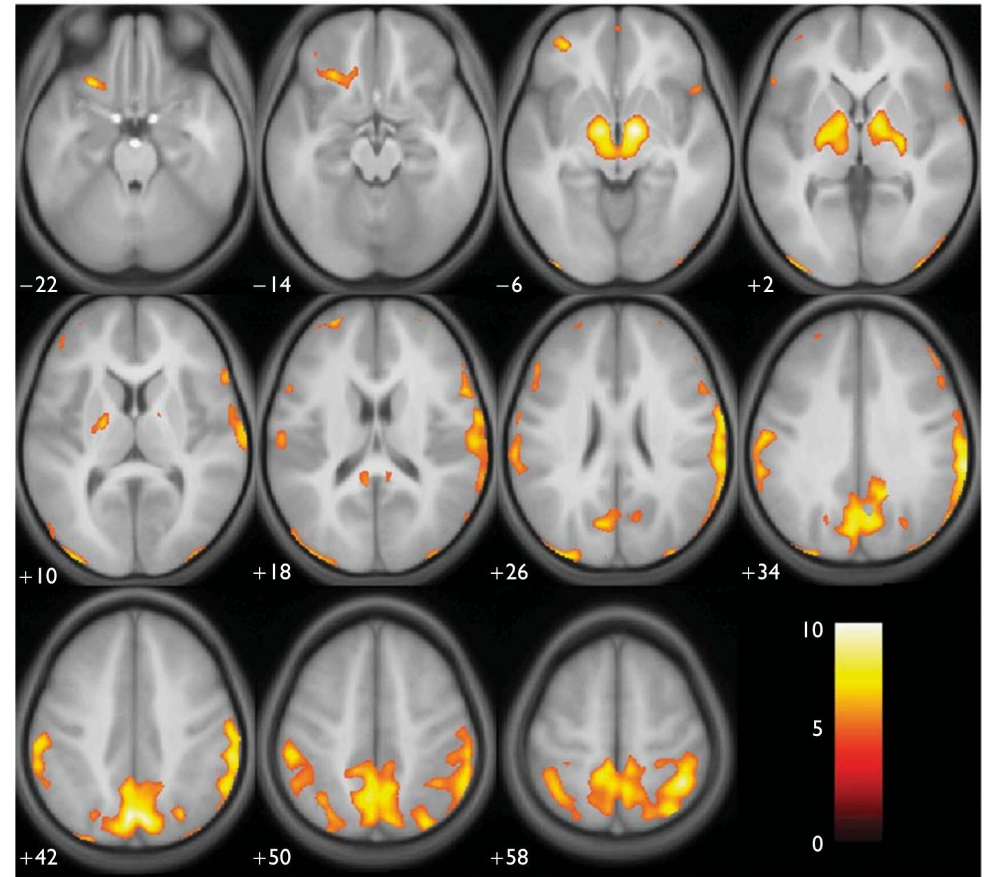Significance maps of negative correlation of gray matter