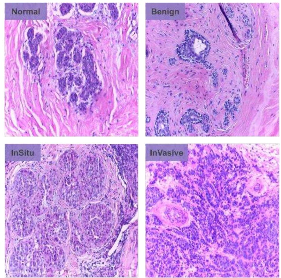Figure 1 - from Breast Cancer Histological Image
