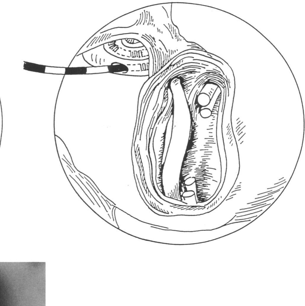 (a) schematic representation of in- tracanal right an