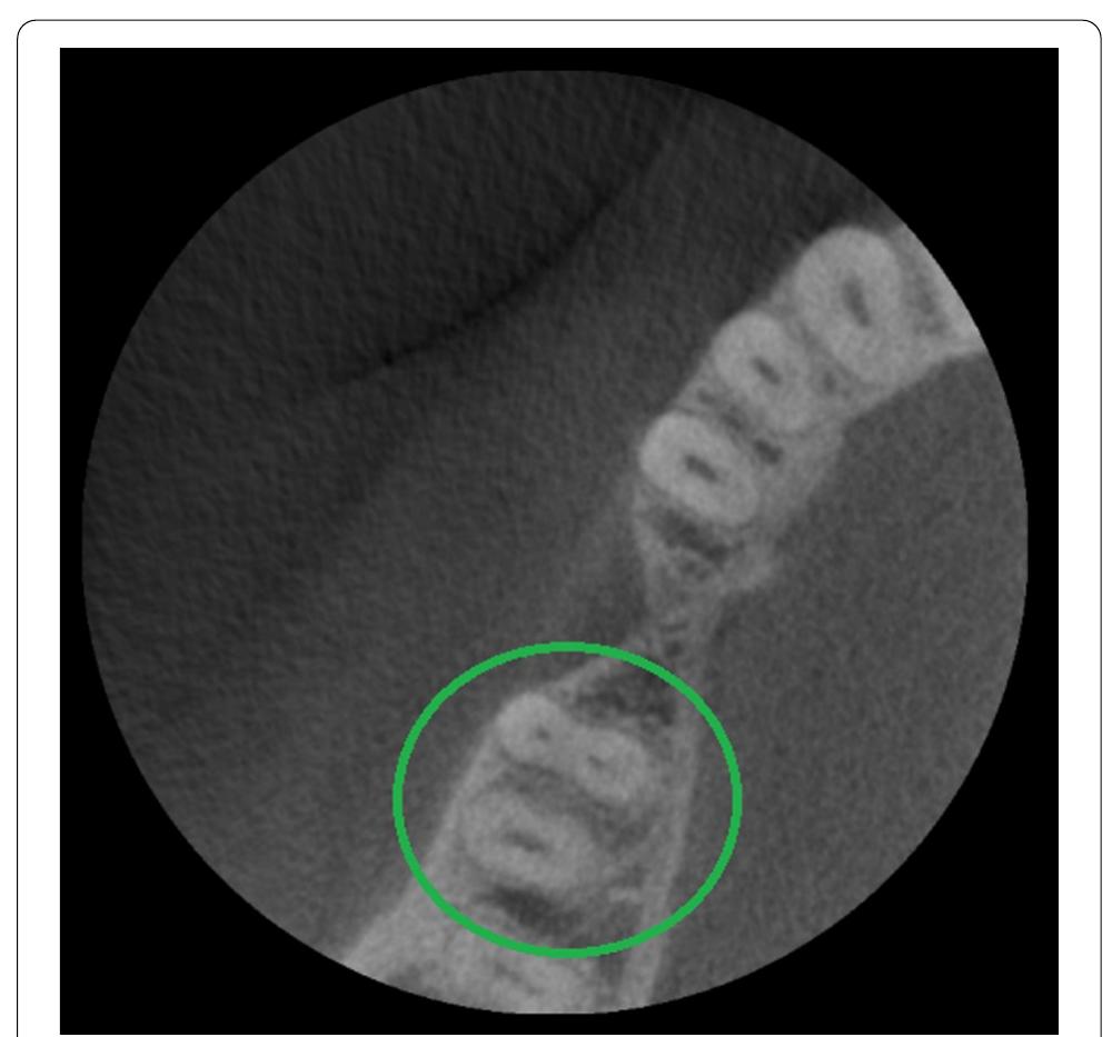 Axial view from cbct scan showing mandibular second molai