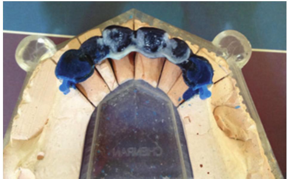 ‘igure 3: wax up of maxillary anterior bridge with 1ale