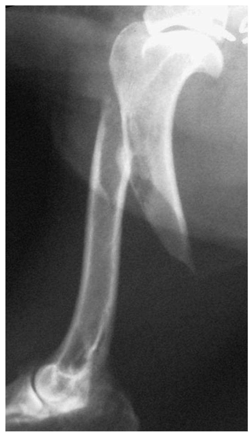 A fracture of the proximal humerus requires surgical