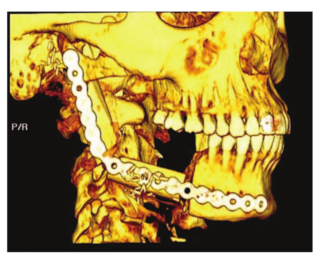 Ct scan 8 months after surgery. fig. 2. complete intraoral