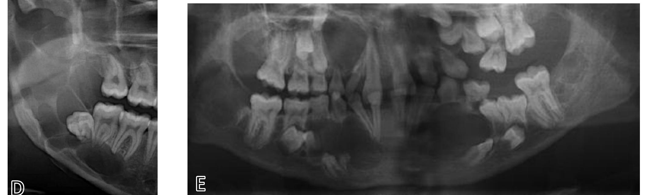 Radiographical pictures of okc. (a) unilocular lesion in the