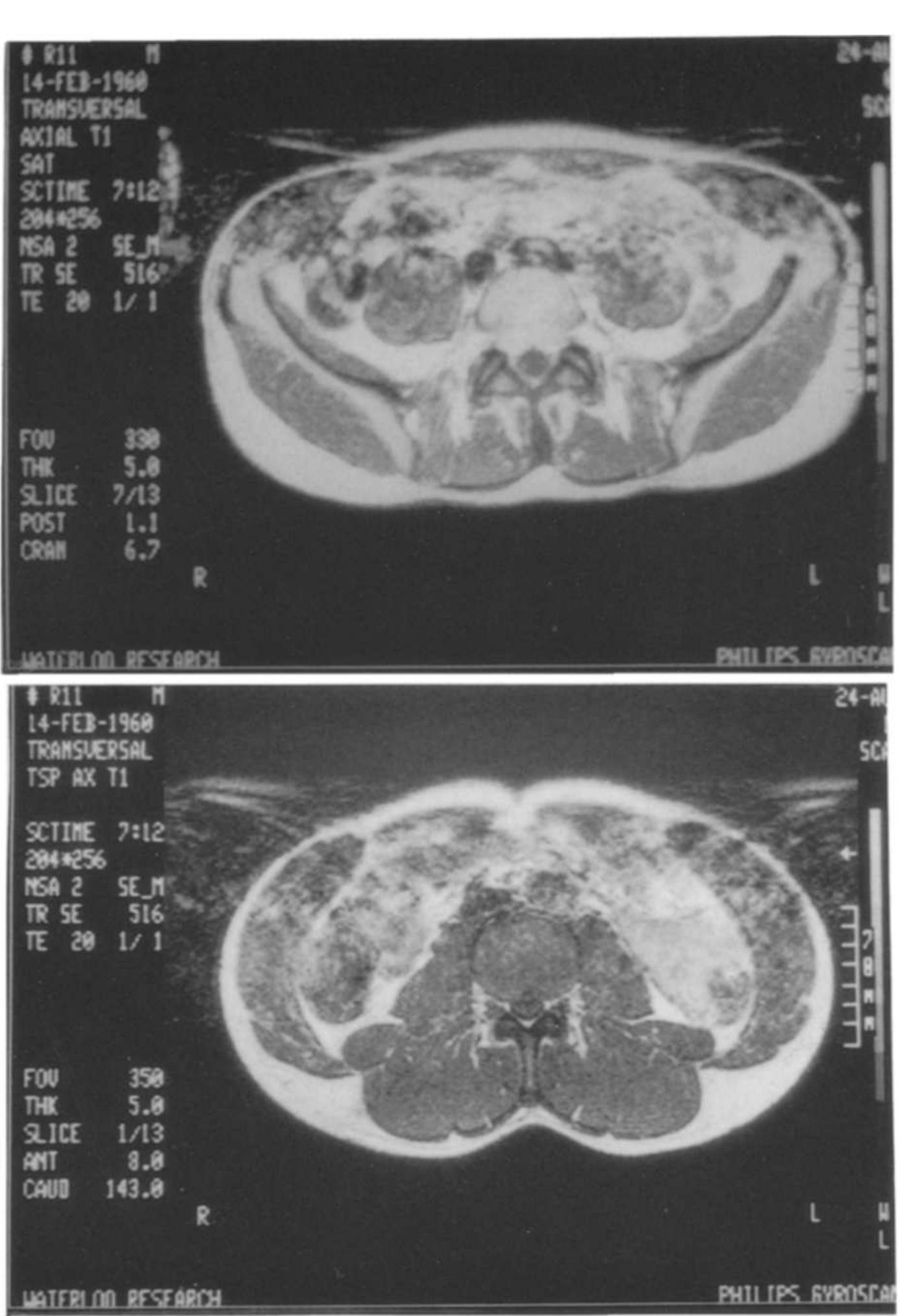 Transverse mri scans at the l5 and l3 levels showing the