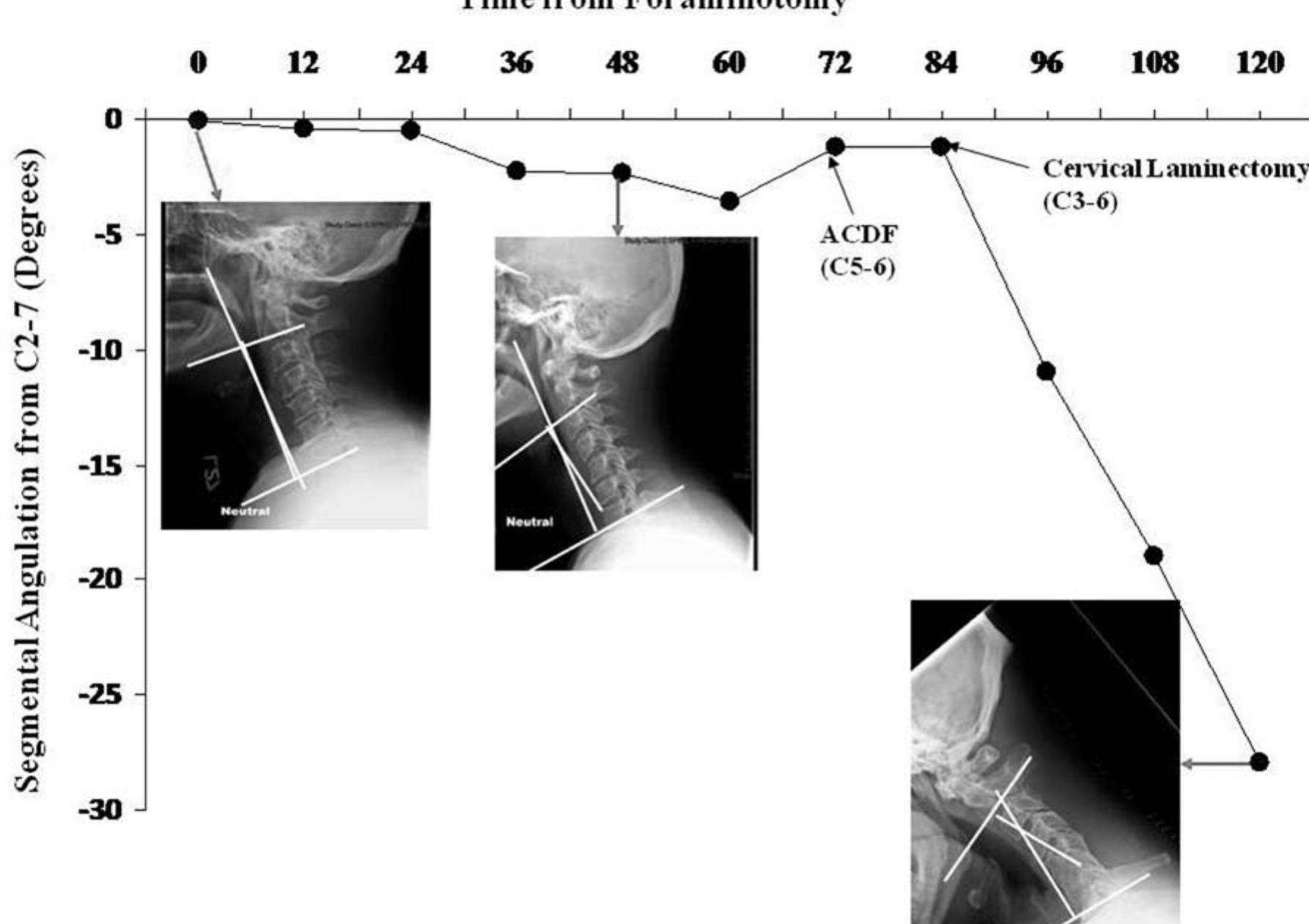 Fic. 4. development of postlaminectomy deformity. this