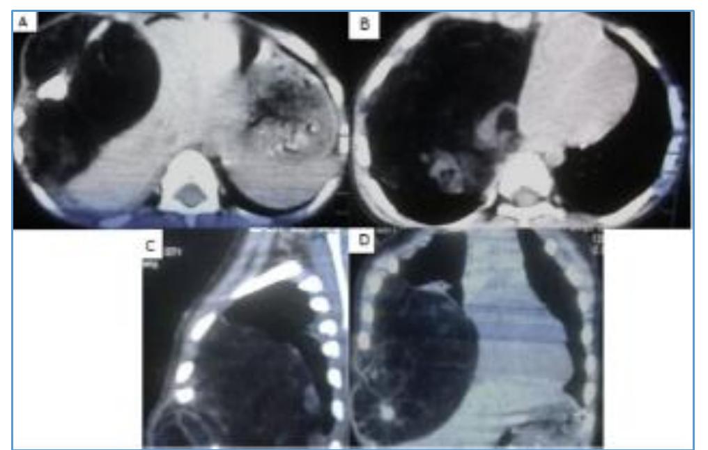 (a, b axial; c sagittal; d coronal images) showing a fat