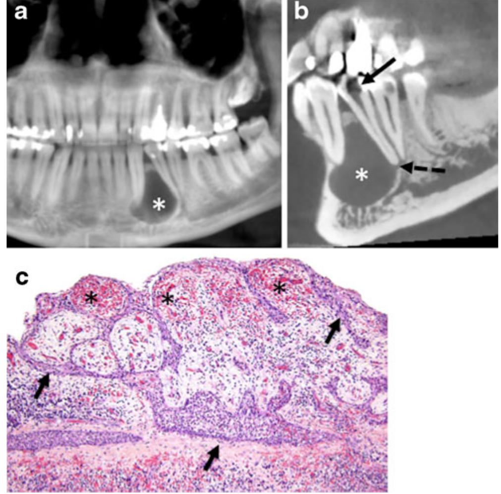 Radicular cyst. a opt. unilocular radiolucent lesion with