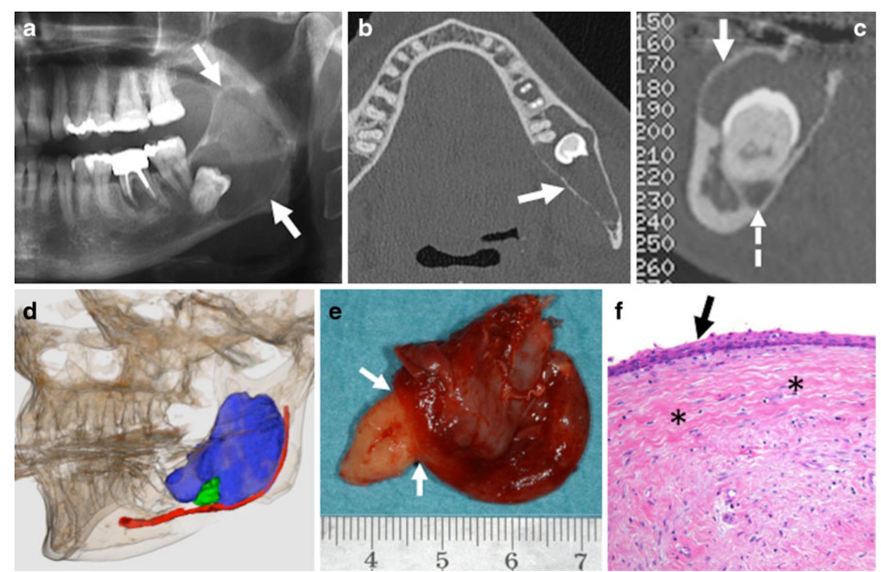 The cyst is attached at the level of the tooth neck and