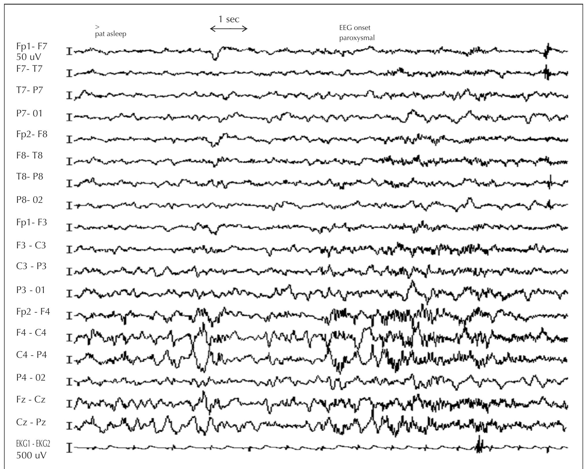 Ictal pattern in a patient with frontal lobe epilepsy: