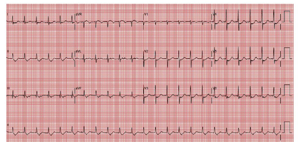 Patient b. 12-lead ecg, ventricular rate 138, and svt.