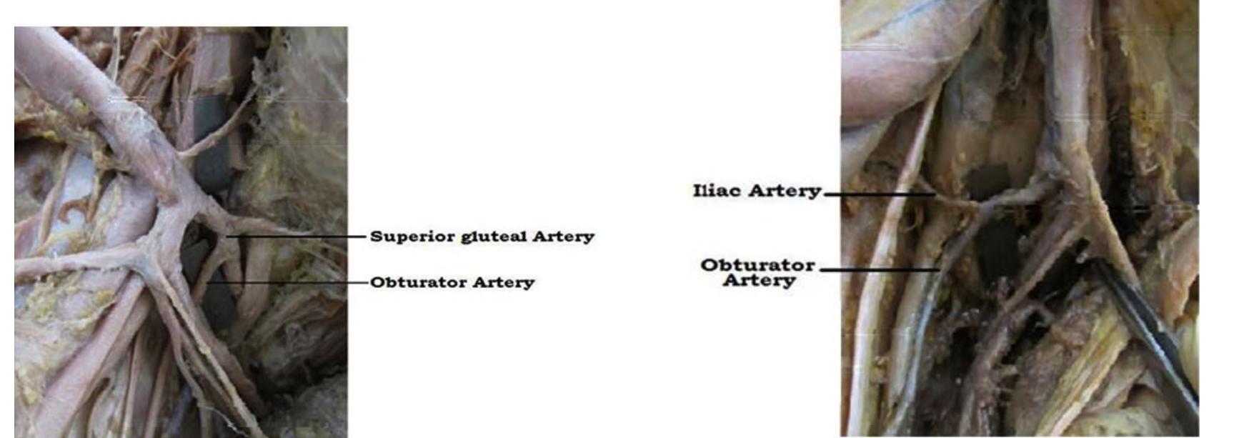 Origin of obturator artery from superior gluteal —f artery