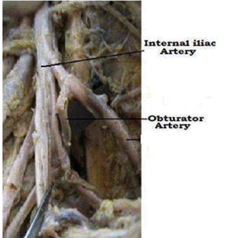 Origin of obturator artery from posterior division of