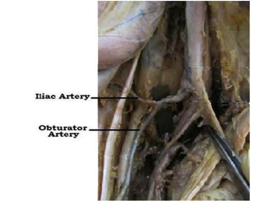 Origin of obturator artery from inferior epigastric artery