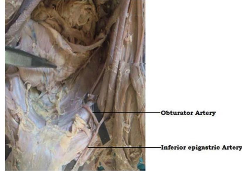 Length of obturator artery, thus providing an added