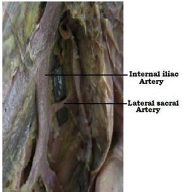 Origin of lateral sacral artery from trunk of internal iliac