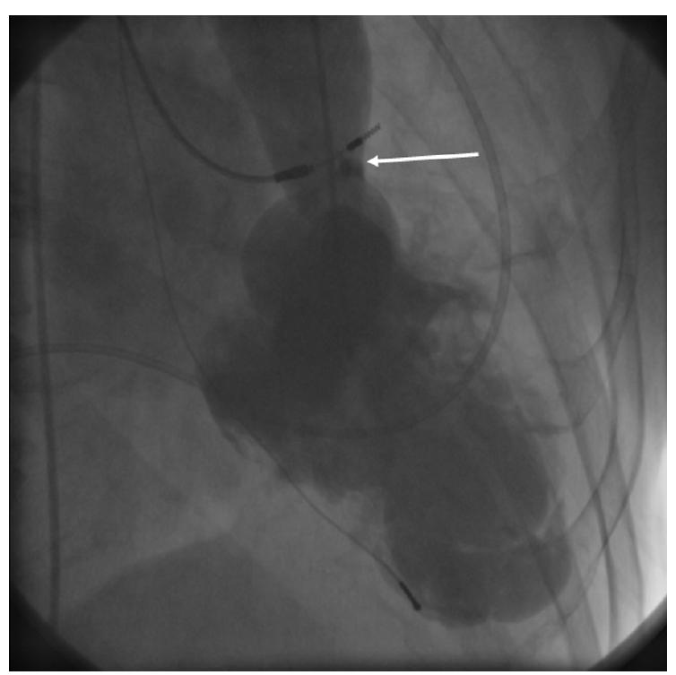 Left ventricular angiography in 1950 showing svas (arrow)