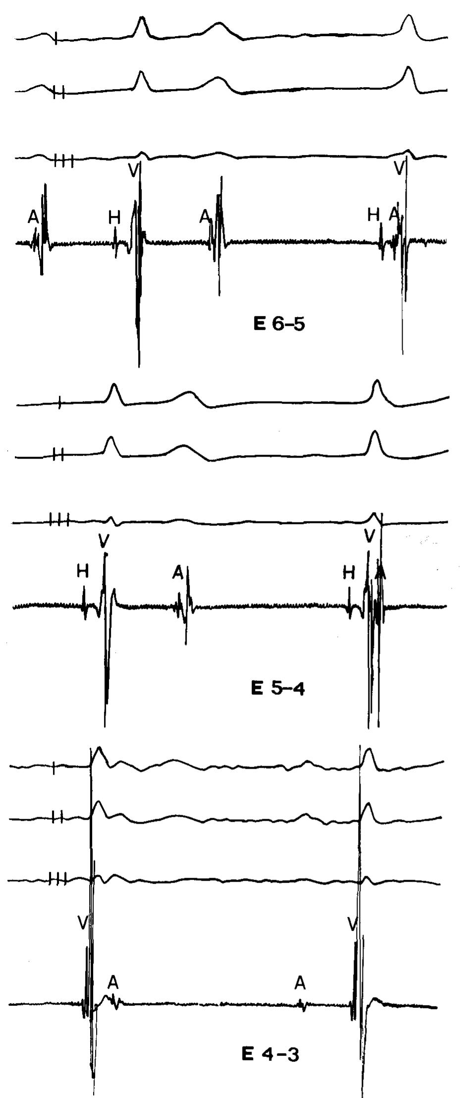 Atrial (a), his bundle (h) and ventricular (v) activation