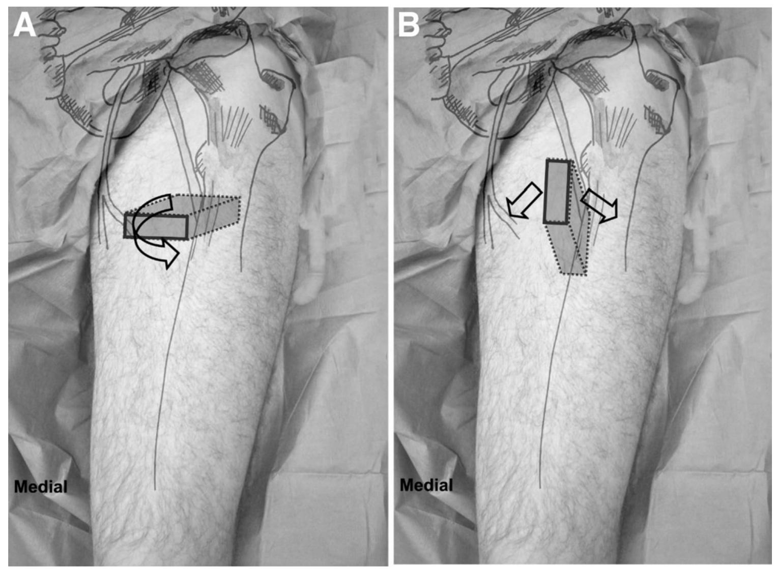 Figure 1 Ultrasound Guided Anterior Sciatic Nerve Block 7865