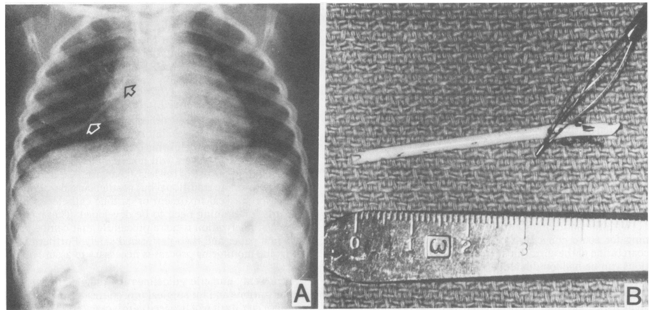 —the photos show catheter retrieval of a catheter-tip