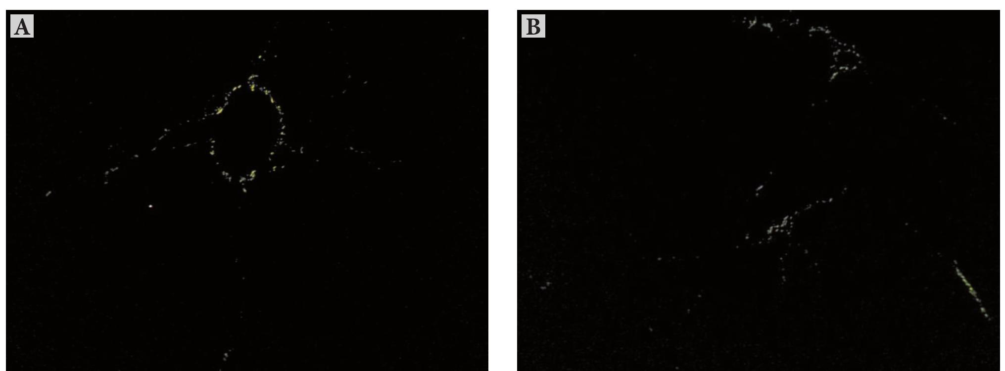 Histopathological picture of fibrosis in the control group