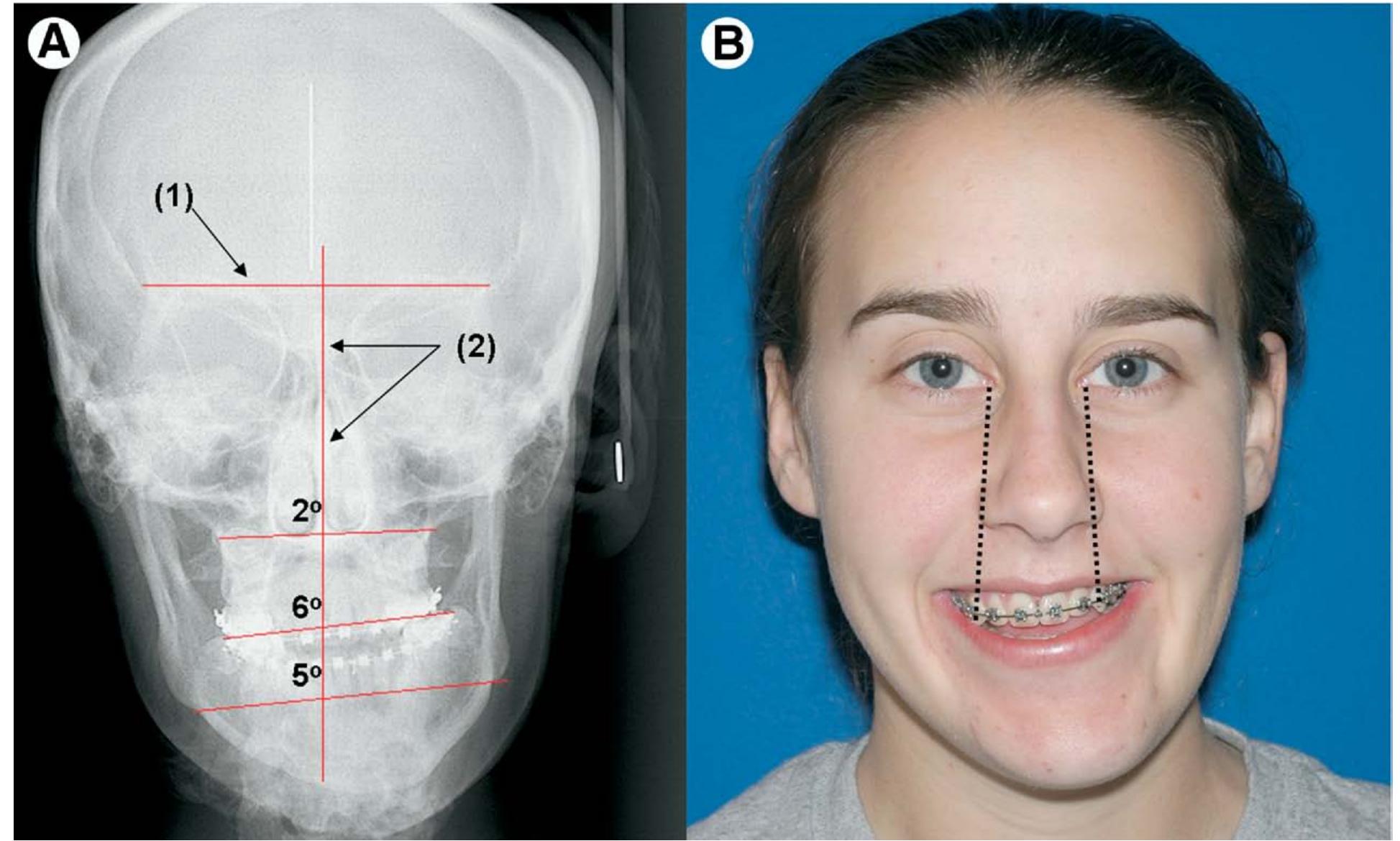 Measurement of occlusal cant in the maxilla. a, the