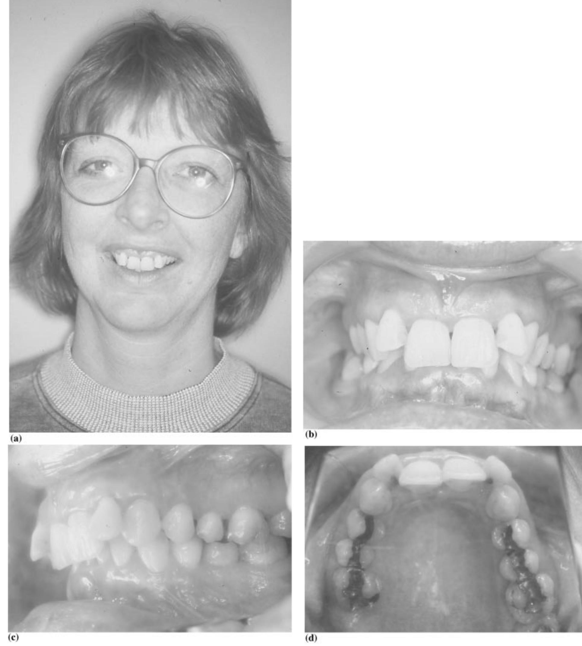Case bp. a) full-face, b) intraoral frontal, c) lateral and