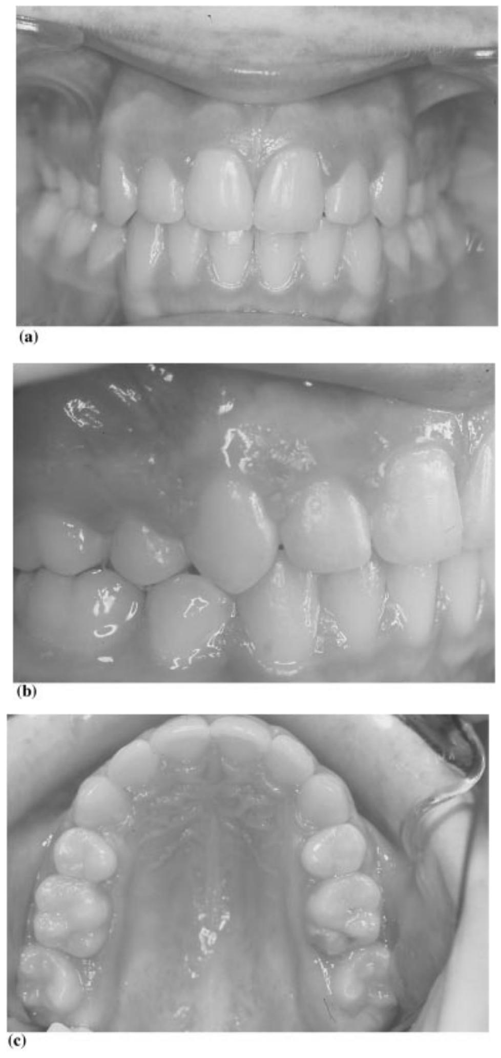 A) intraoral frontal, b) lateral and c) occlusal views after