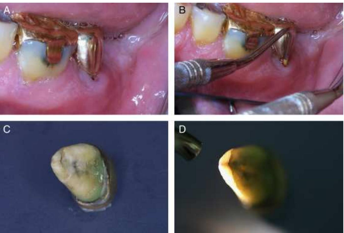 (a) this mandibular second molar had a history of vertical