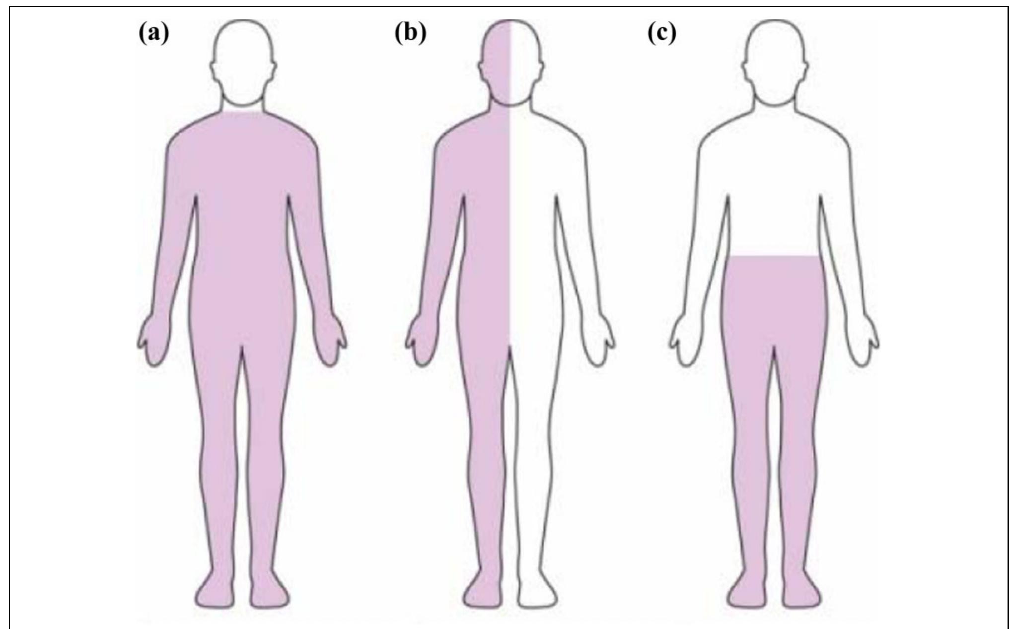 Types of paralysis, where the coloured portion is paralysed.