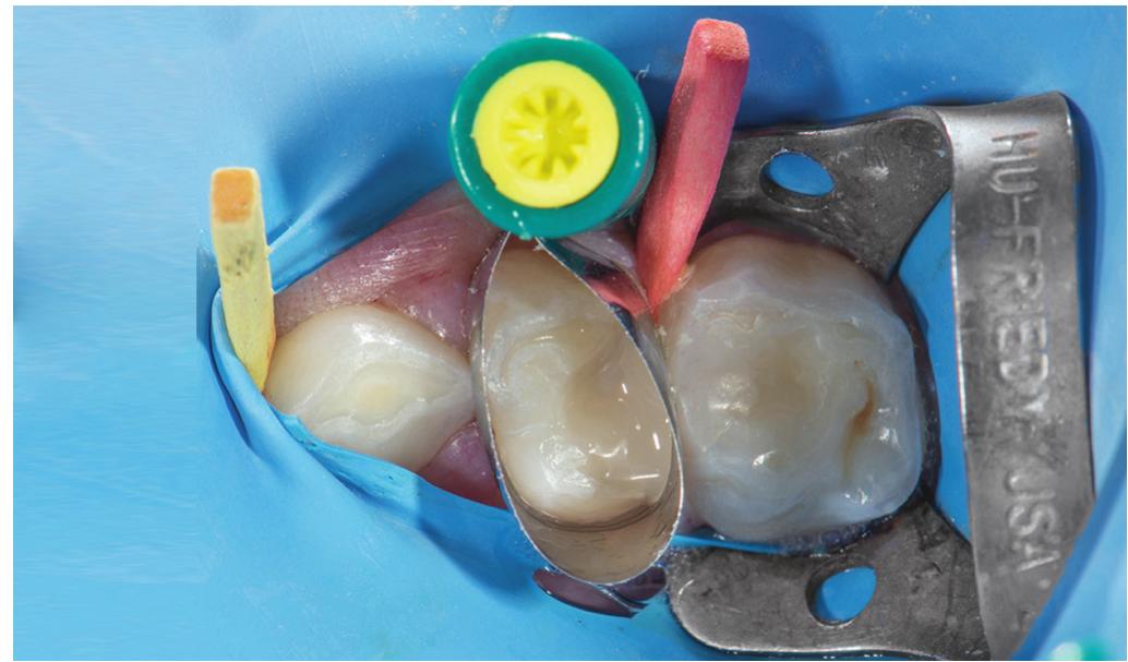 Intraoral picture of the tooth after the placement of the