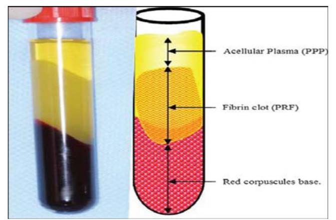 Figure 1 - from Platelet Rich Fibrin and its Applications in