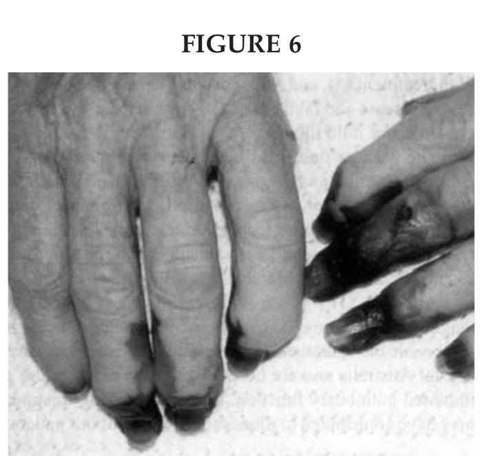Distal digital gangrene of the fingertips in a 45-year-old