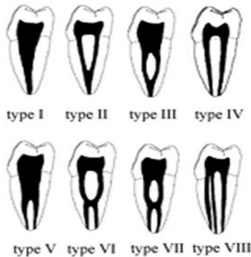 Vertucci’s classification of canal configuration