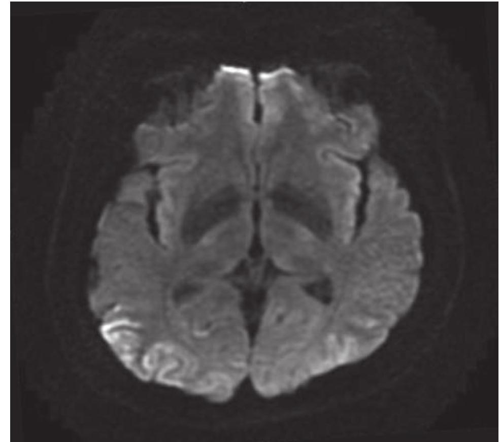 Brain mri (dwi). “cortical ribboning” - restricted diffusion