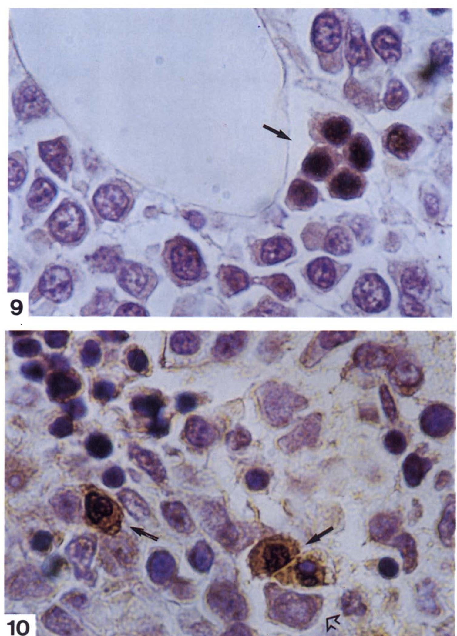 (PDF) Abnormal localization of immature precursors (ALIP) in the bone ...