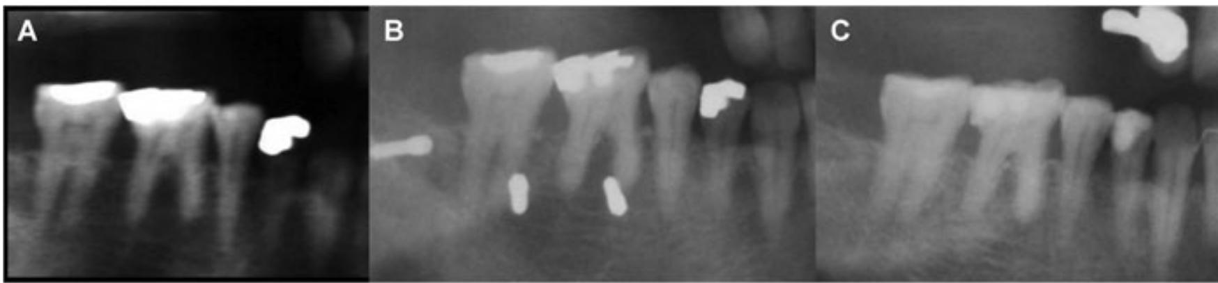 Radiographs of the patient during treatment showing the