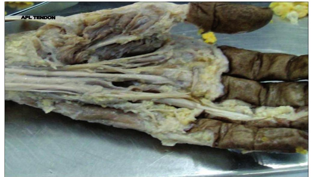 There were 3 female and 22 male cadavers. the apl muscle was