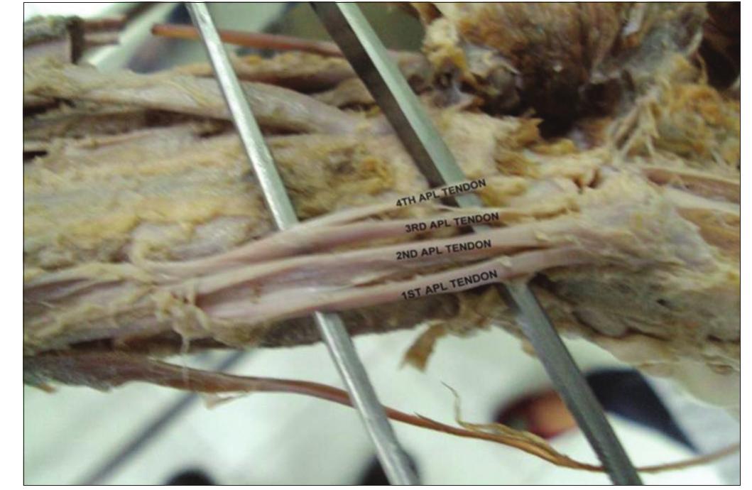 Quadruplicate abductor pollicis longus tendon inserted into