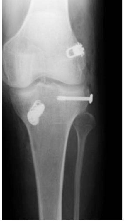 Postoperative anteroposterior radiograph of a patient who