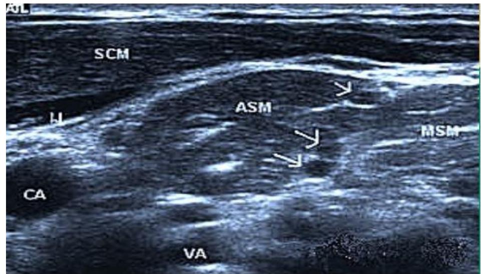 - asm&msm, anterior and middle scalene muscles; scm,