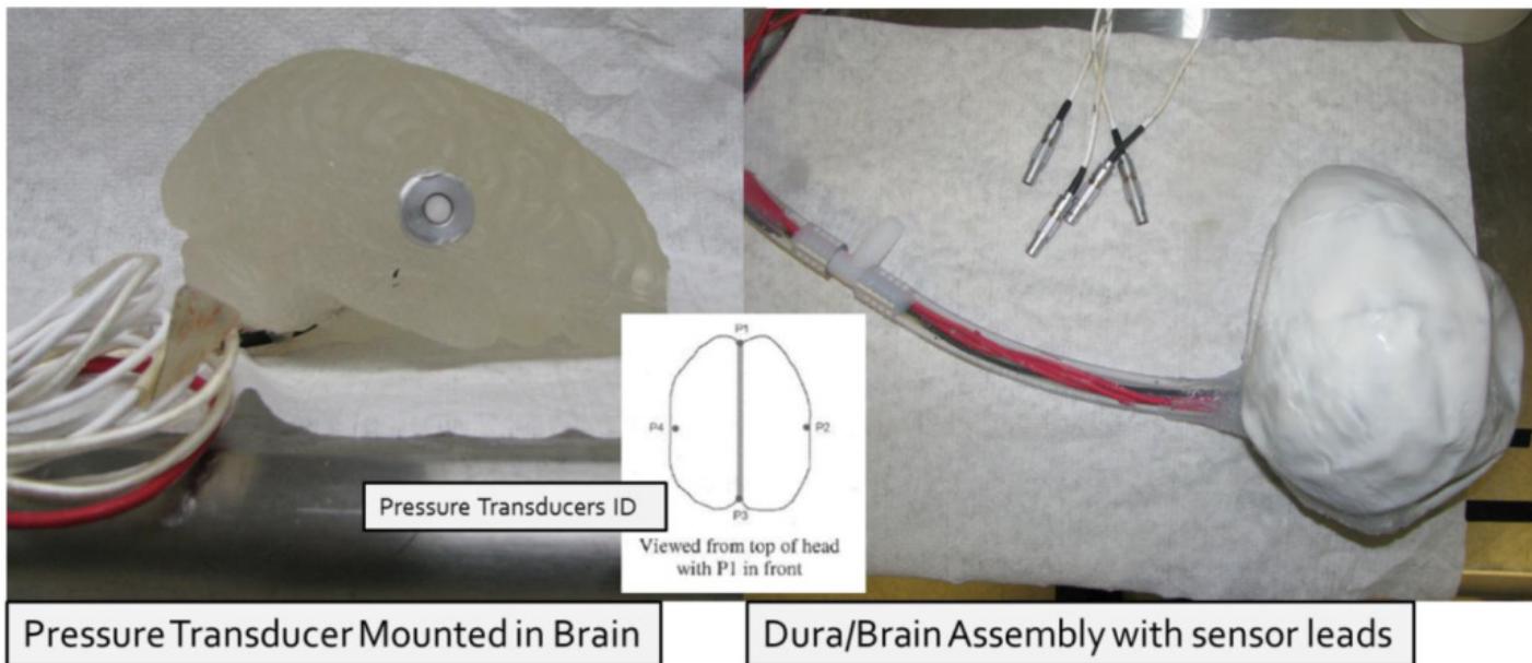 Intra-cranial pressure transducer deployment method — left