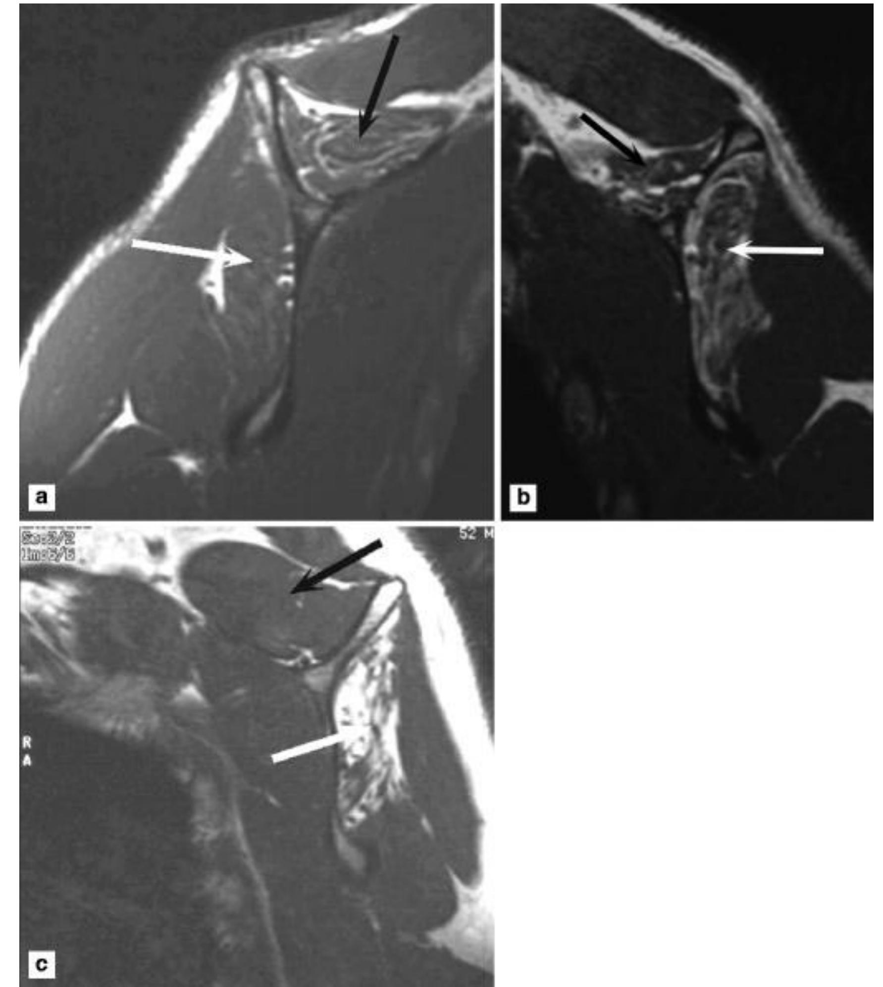 Figure 4 - Suprascapular nerve entrapment: evaluation with