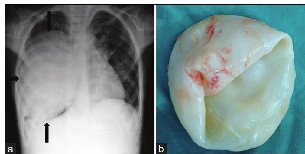 Lung hydatid cyst in a 10-year-old boy. a) chest radiograph