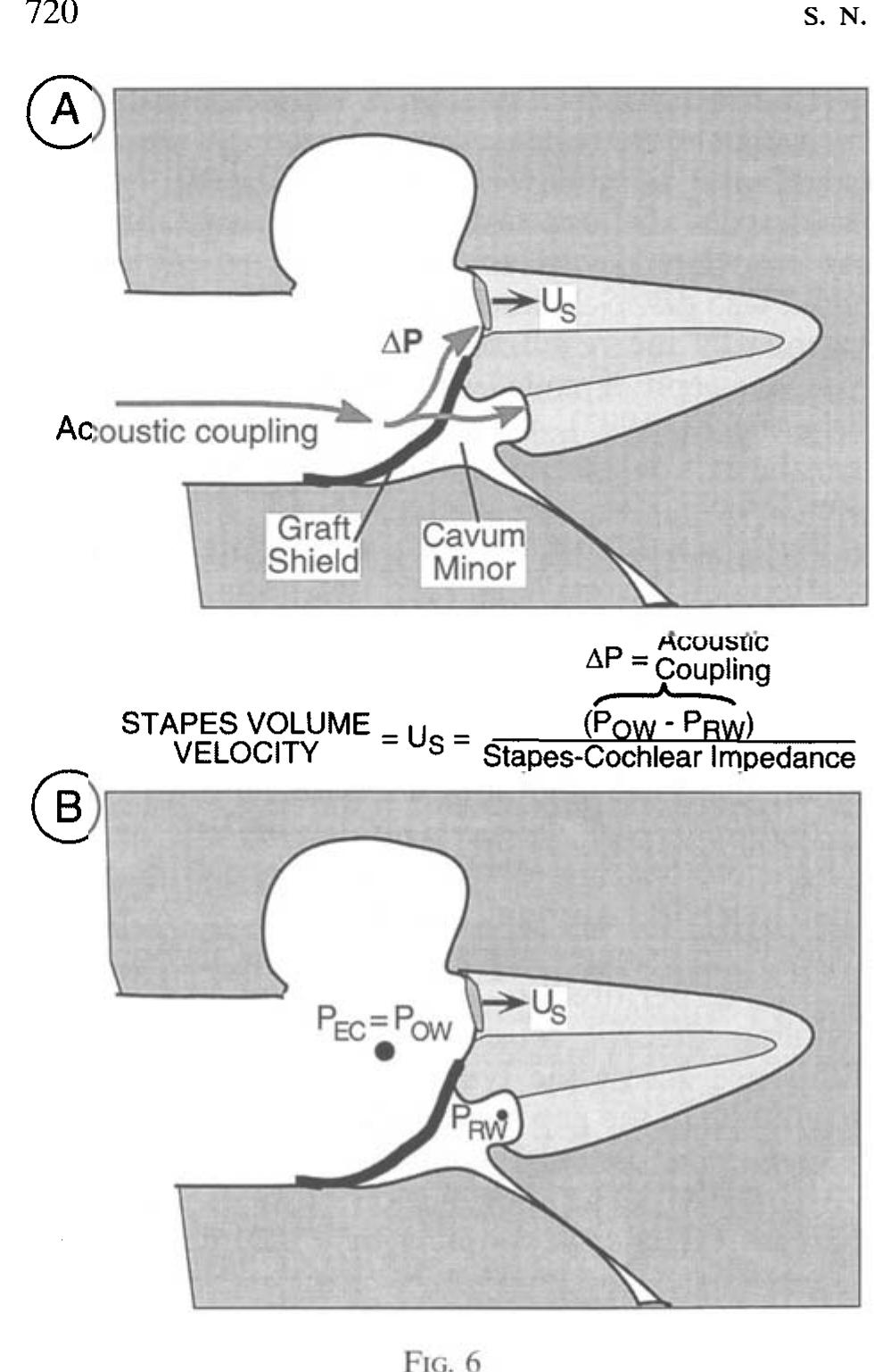 Schematic drawing of type iv tympanoplasty. a. incoming