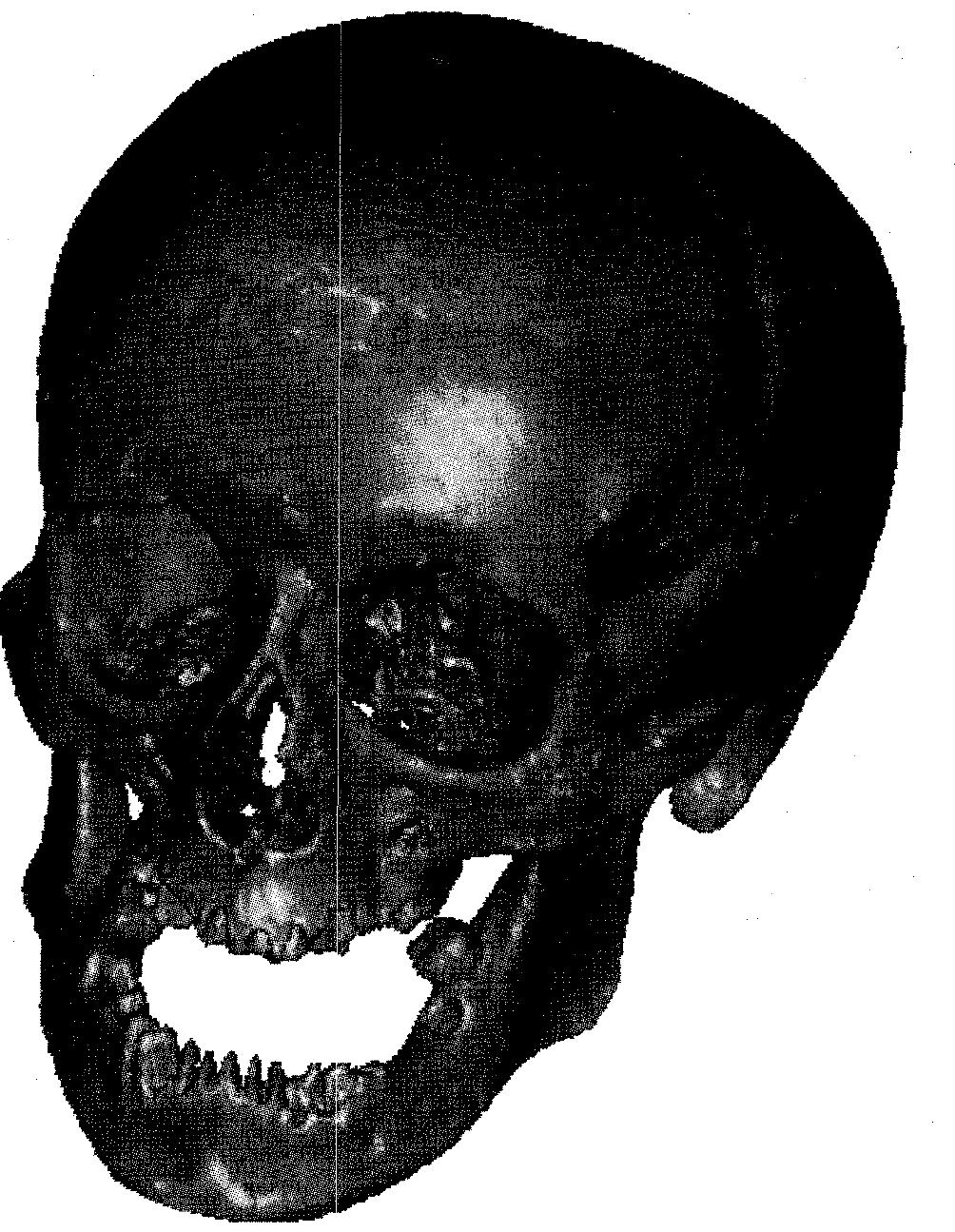 Surface of the cranium for a crouzon syndrome (58k vertices