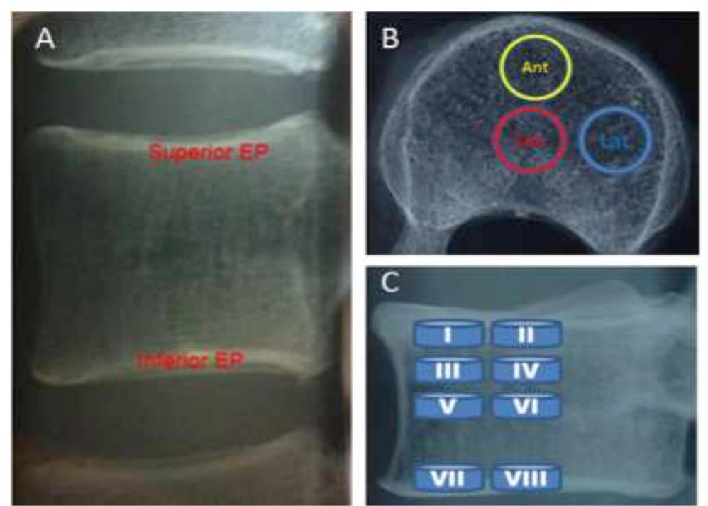 Plain radiographs of thoracic vertebrae. a) lateral view of