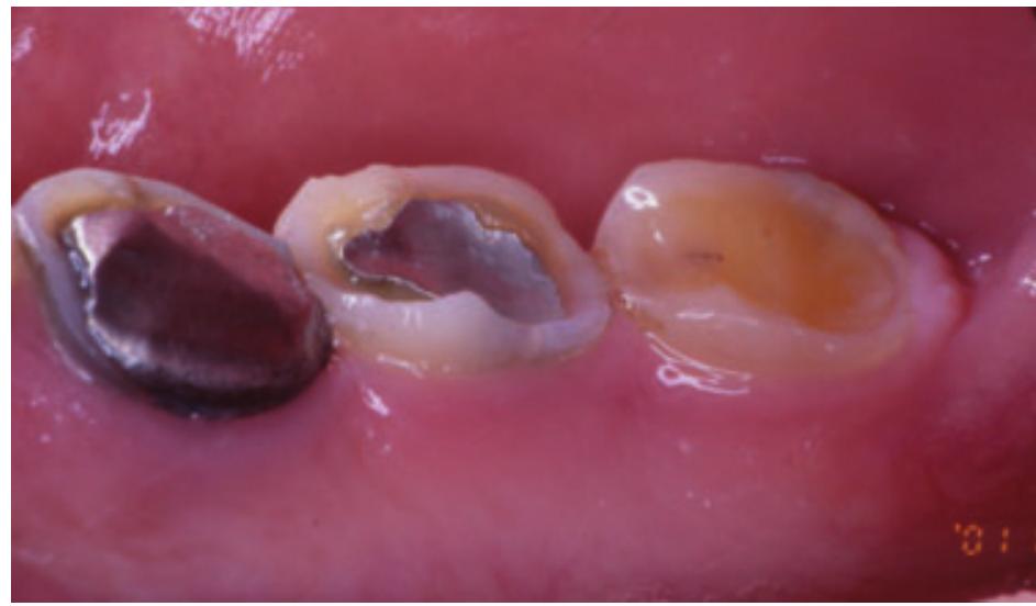 Acid erosion of mandibular teeth from gastro- esophageal
