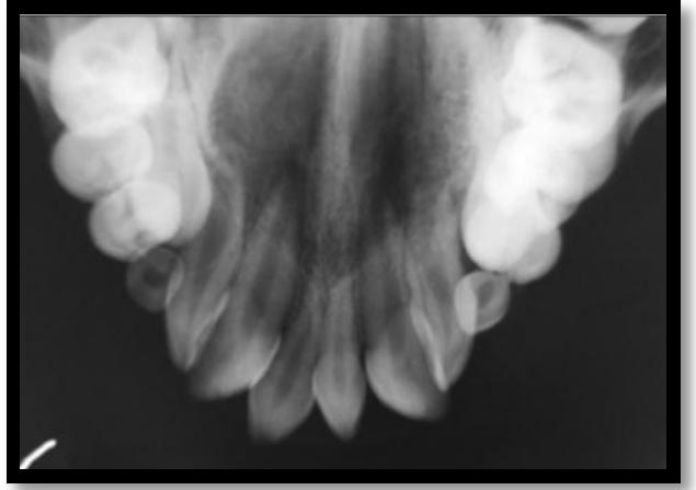 An anterior occlusal radiograph is useful to show the