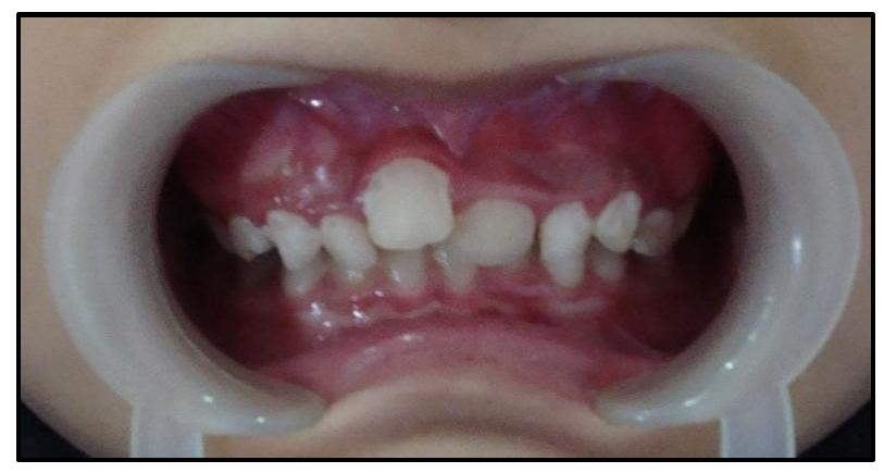 Protrusion of the anterior teeth. the treatment plan for
